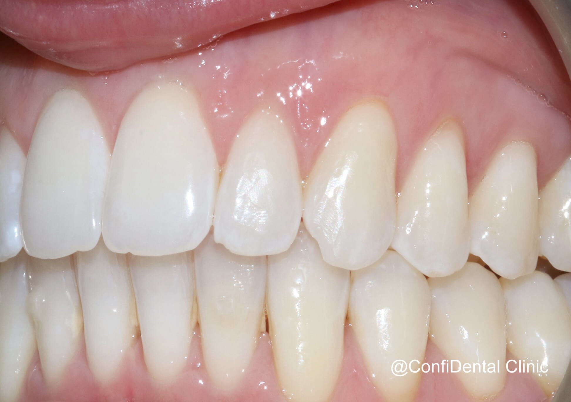 Teeth Straightening in Worcesterpark | Invisalign & Braces ...