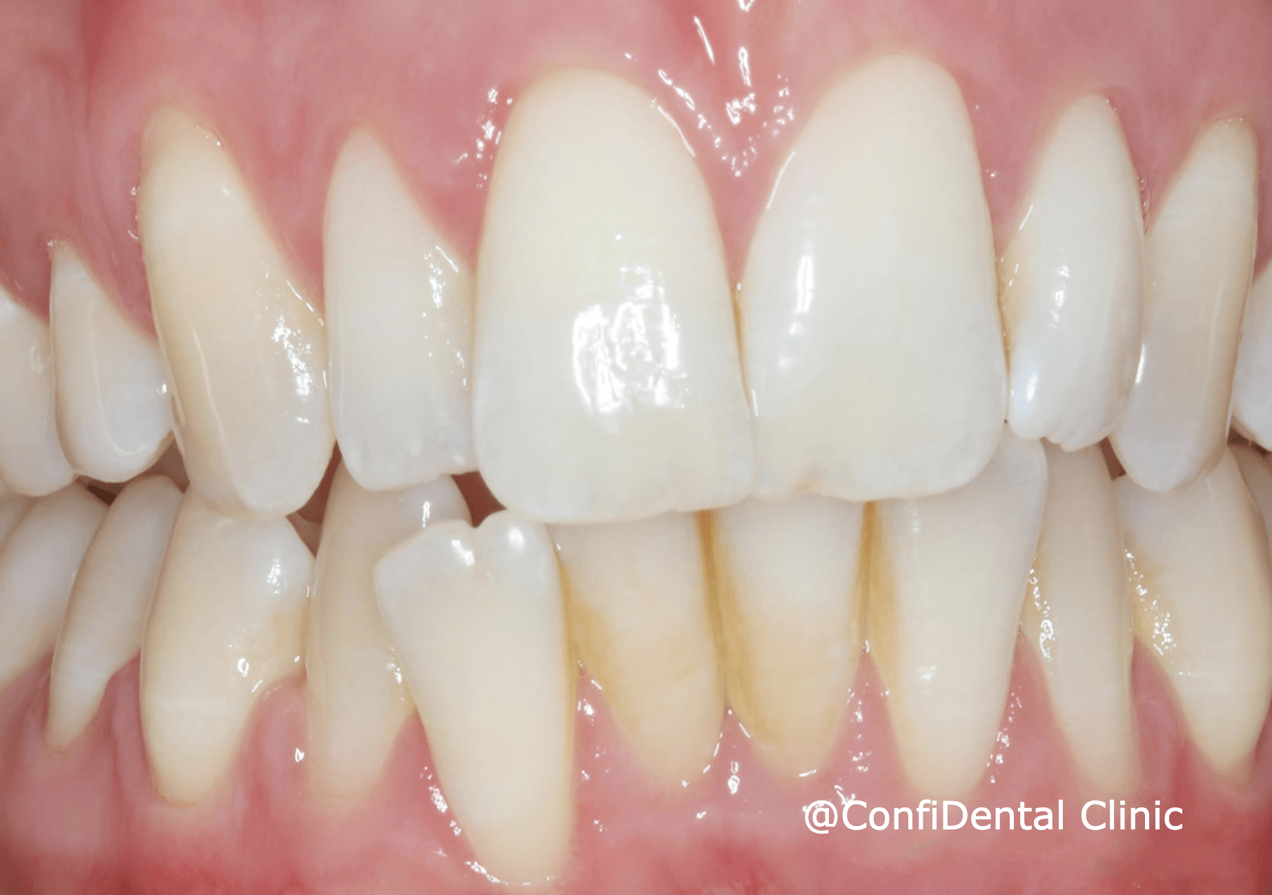 Teeth Straightening in Worcesterpark | Invisalign & Braces ...